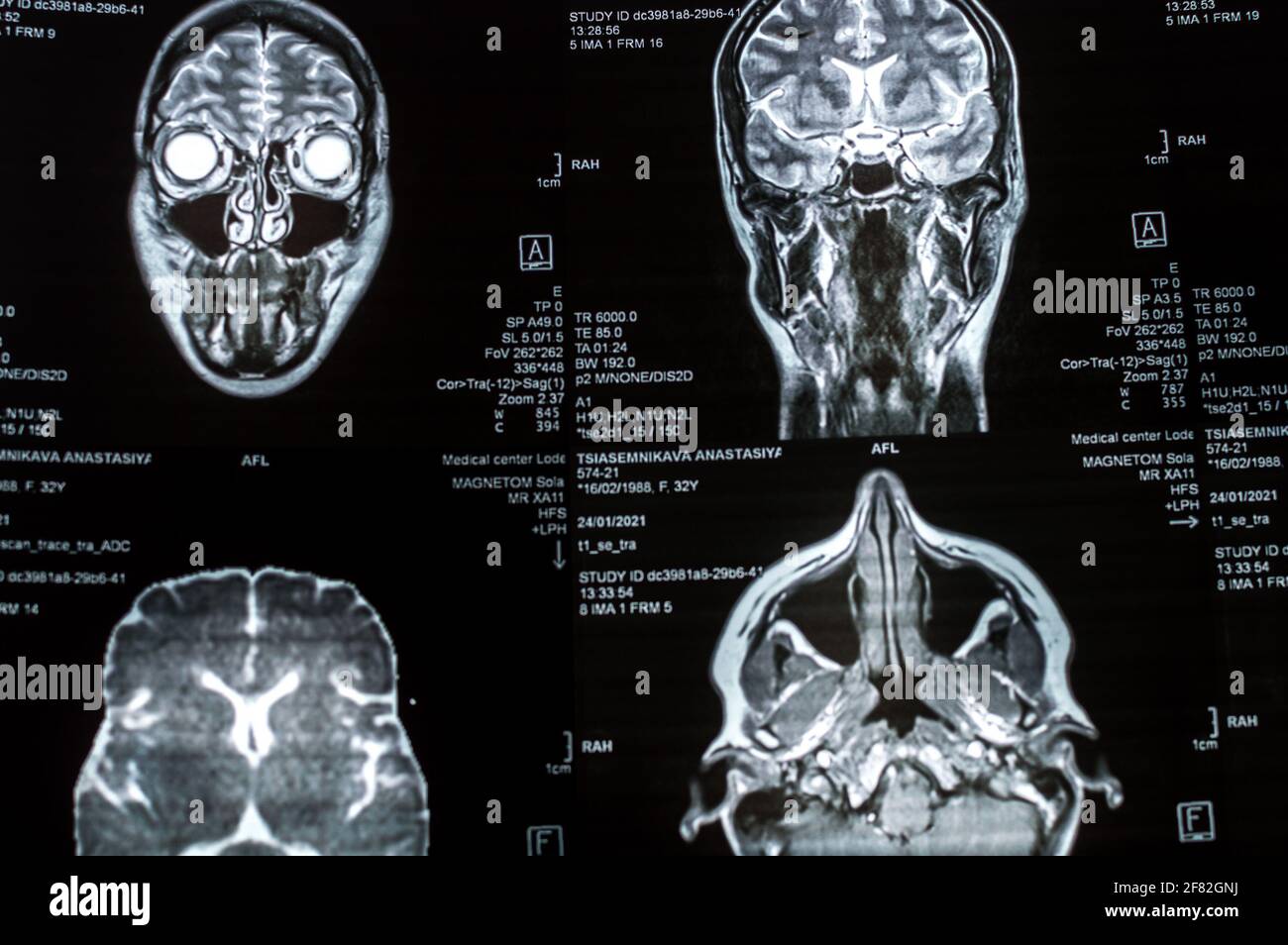 Magnetic resonance imaging of the brain close up. MRI Stock Photo - Alamy