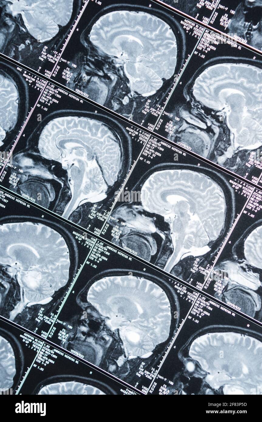 Magnetic resonance imaging, MRI, computed tomography, x-ray image. Head ...