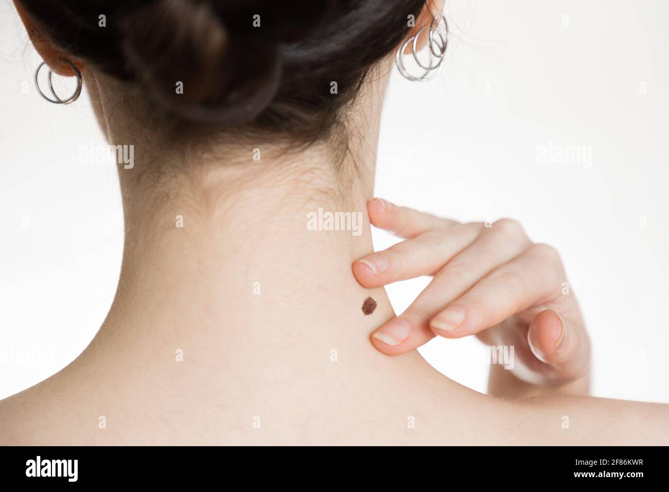 Dermatology. Close-up of a woman's neck. The hand shows a large mole ...