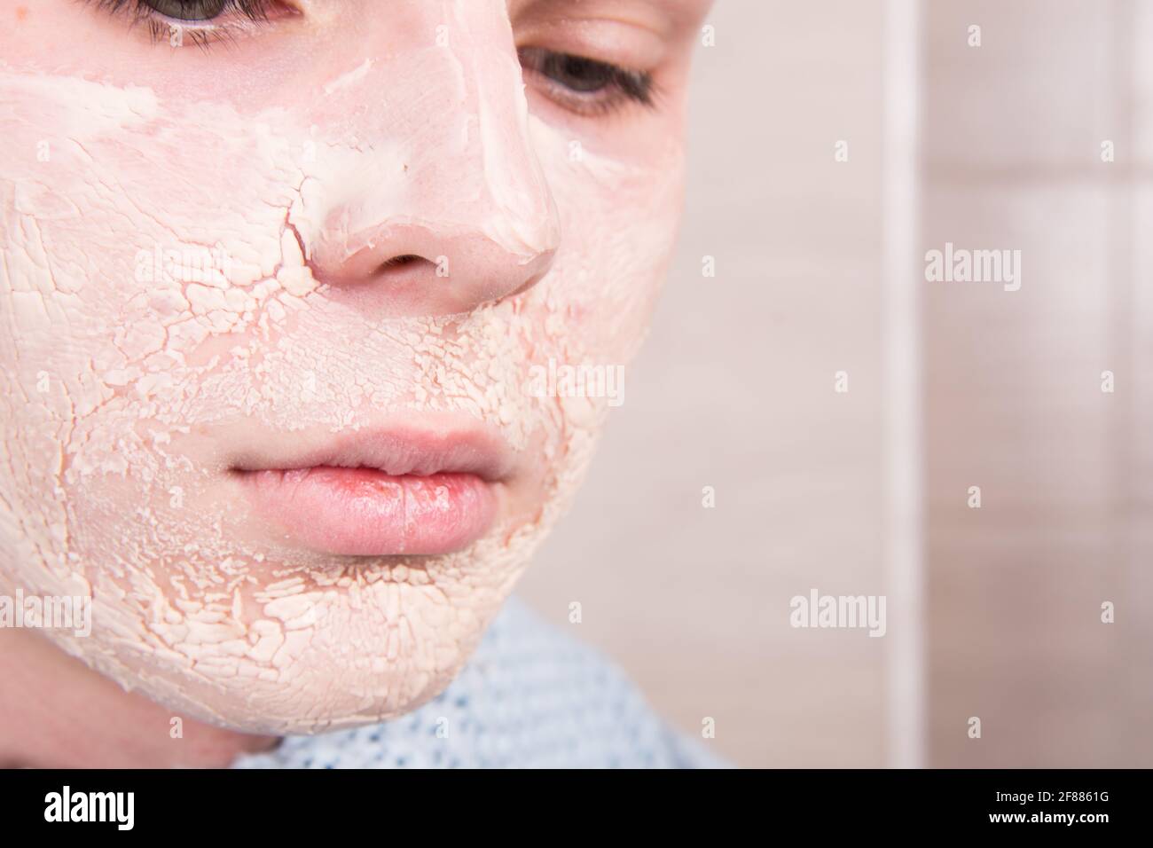 Male beauty. Acne. Skin problems Stock Photo - Alamy