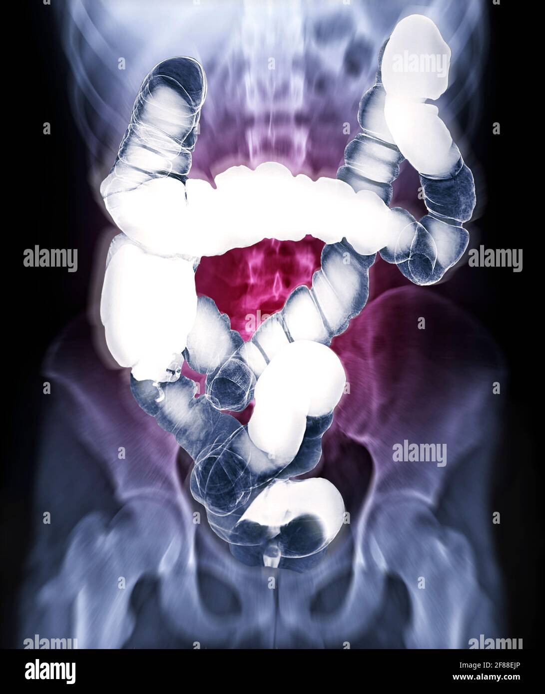 Barium enema large intestine hi-res stock photography and images - Alamy
