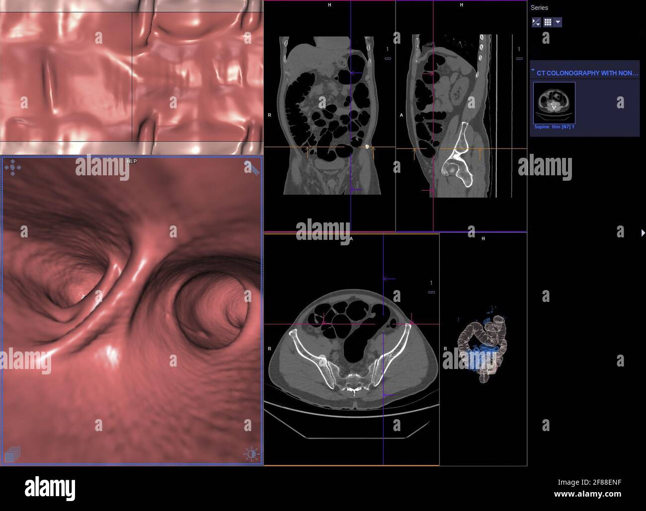 CT colonography or CT Scan of Colon axial view vs Coronal view and 3D ... CT colonography or CT Scan of Colon axial view vs Coronal view and 3D ...