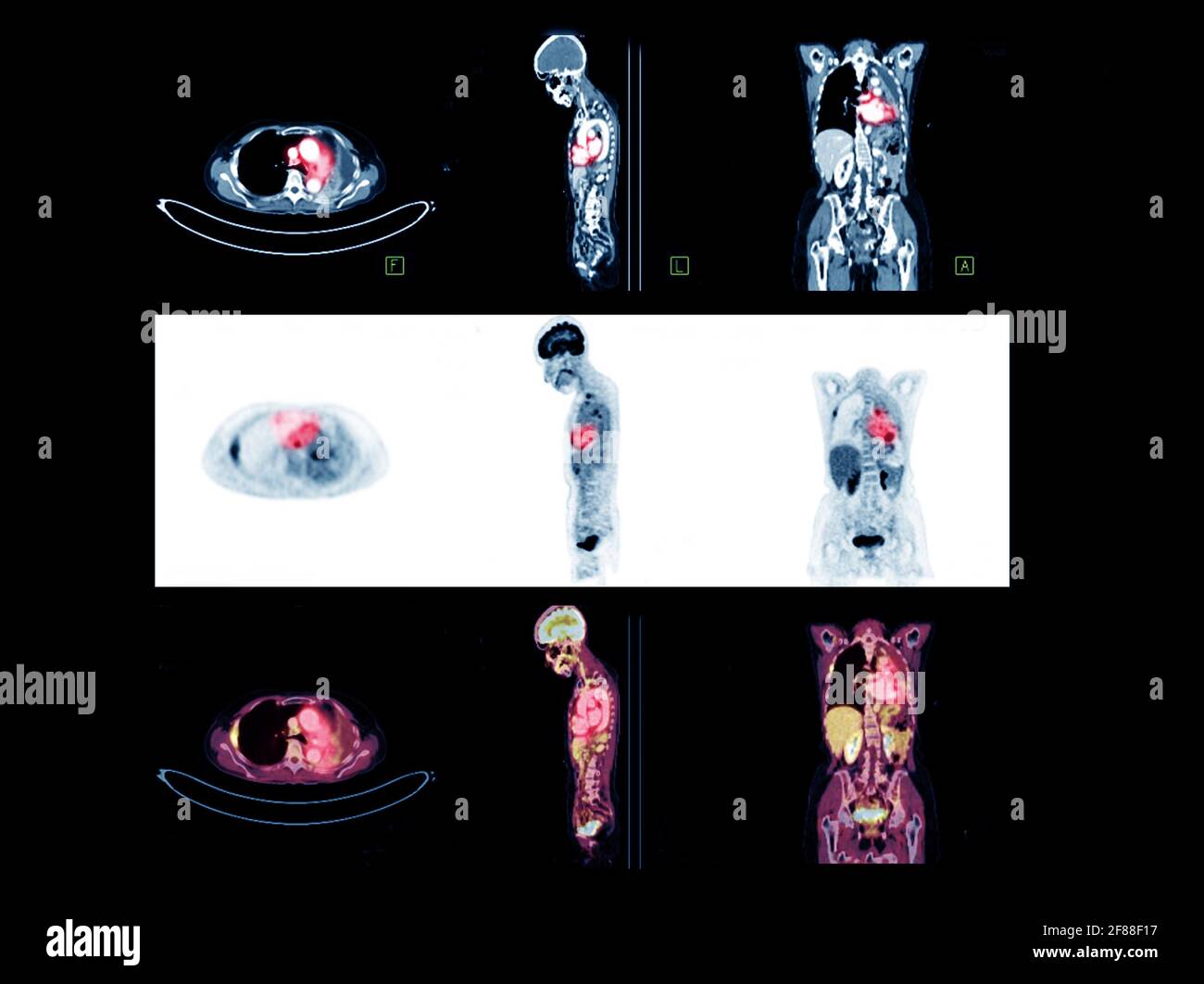 PET Scan image of whole body Comparison Axial , Coronal and Sagittal ...
