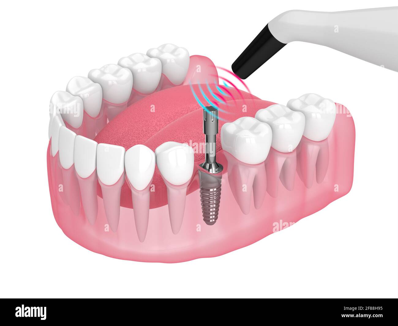 Checking dental implant stability by osseointegration monitoring device ...