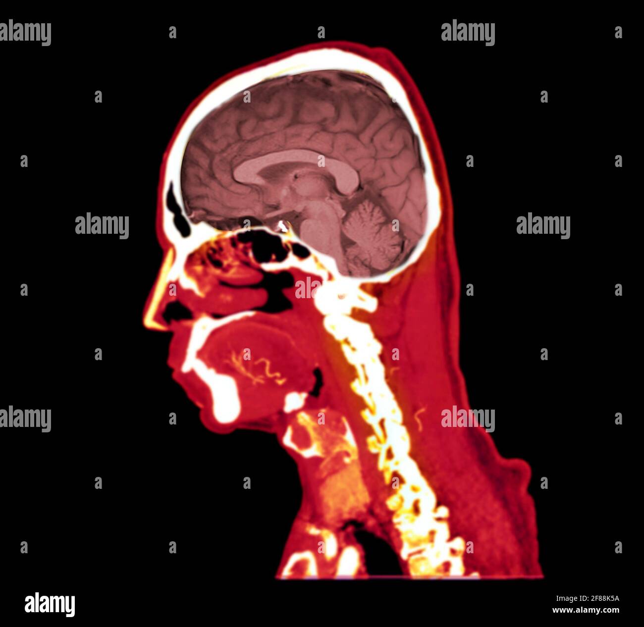colorful of CT angiography of the brain or CTA brain Sagittal view ...