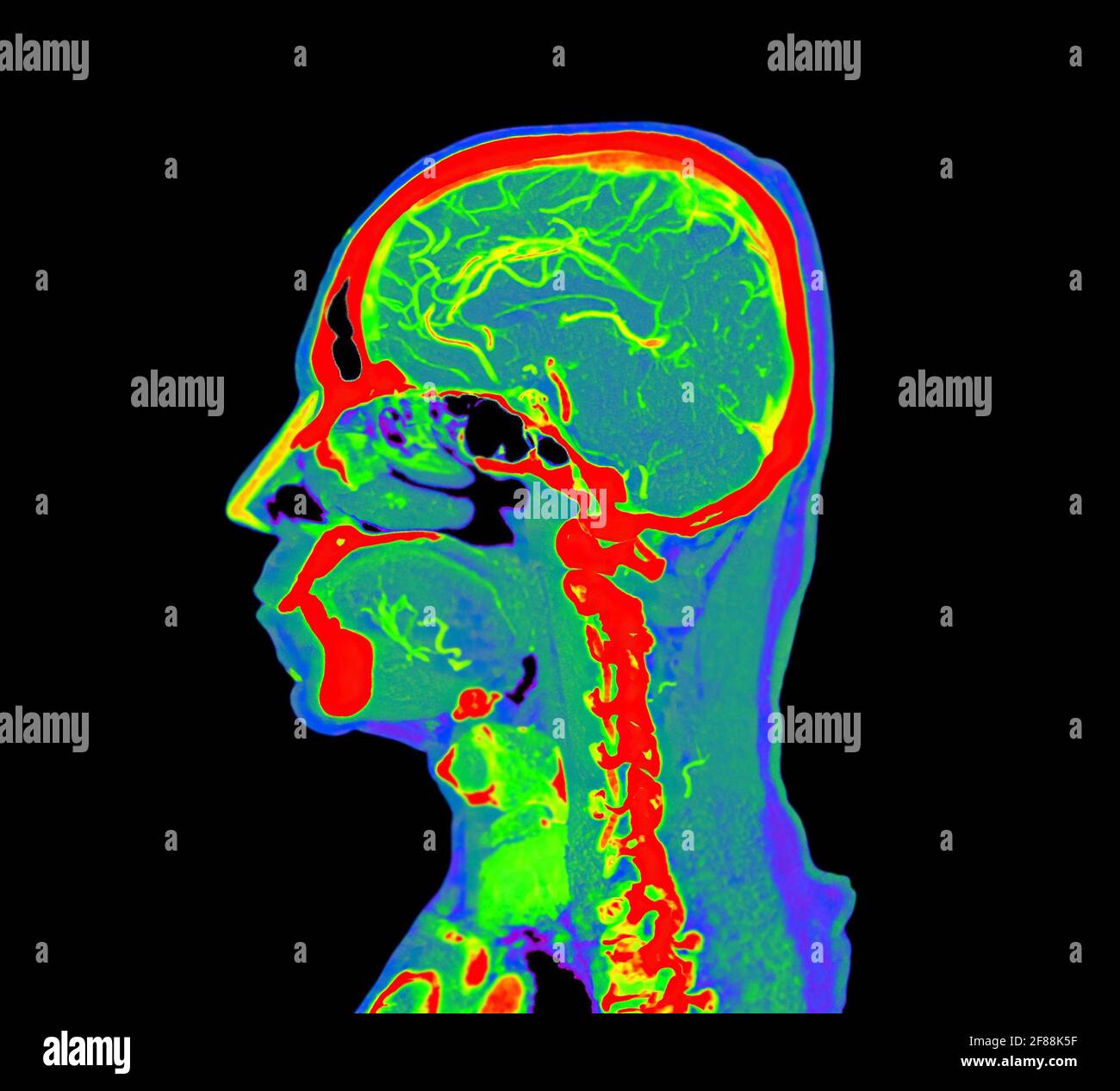 colorful of CT angiography of the brain or CTA brain Sagittal view ...