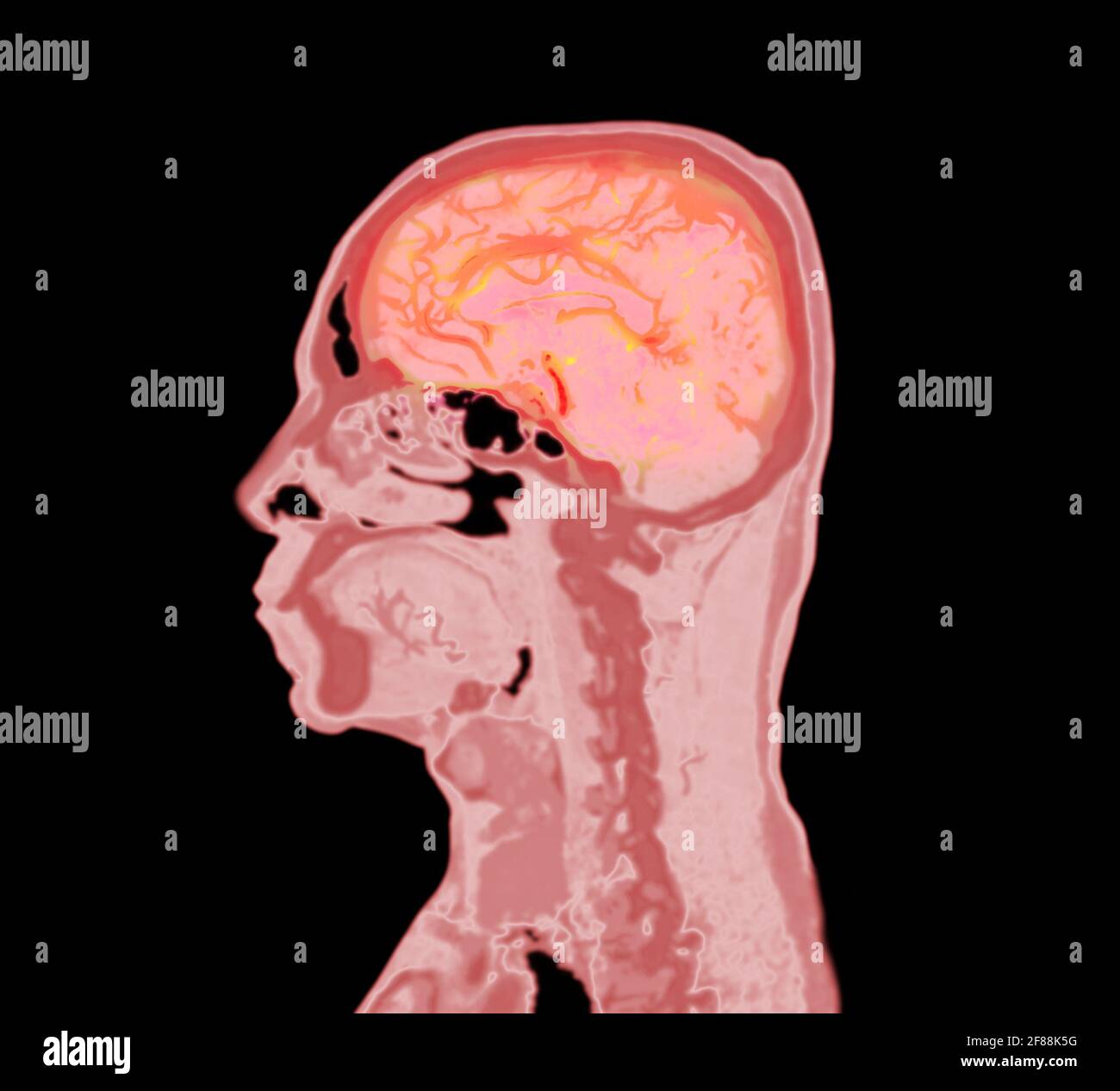 colorful of CT angiography of the brain or CTA brain Sagittal view ...