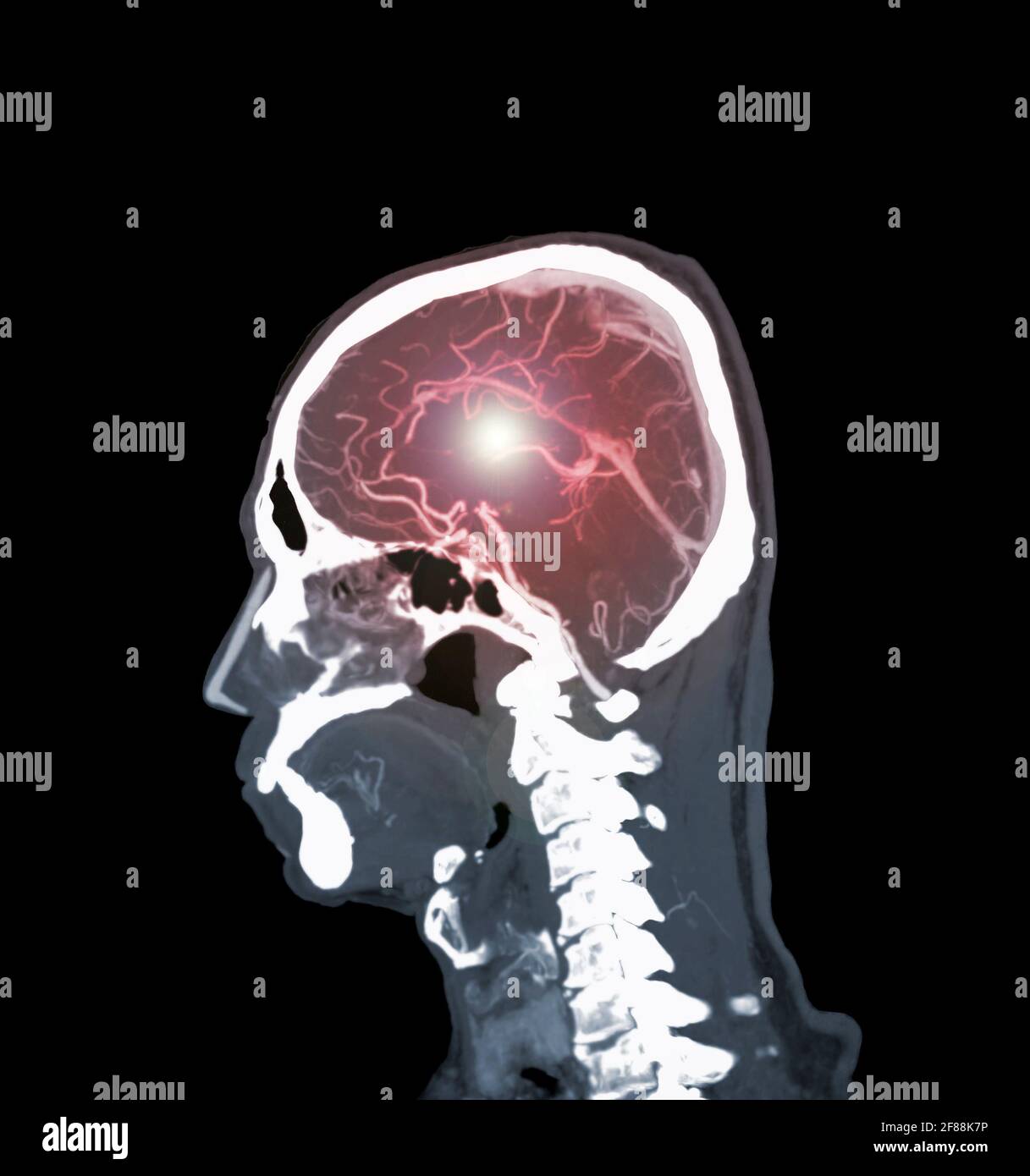 CT angiography of the brain or CTA brain sagitta view Stock Photo - Alamy