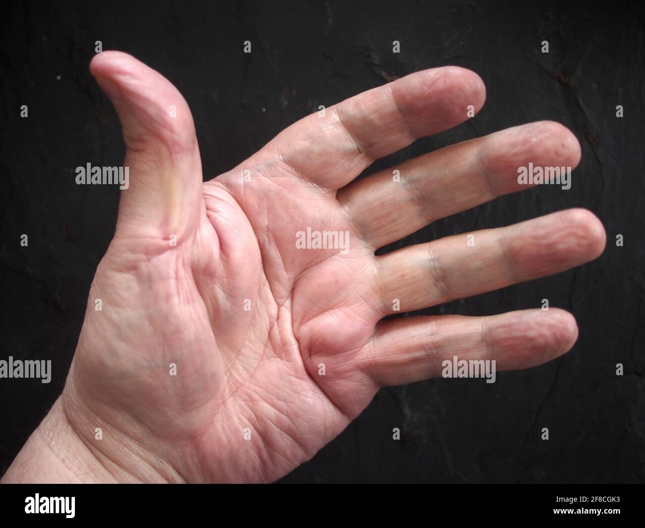 DuPuytren's Contracture in the Left Hand Stock Photo - Alamy