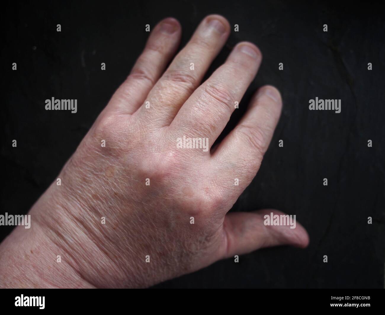 DuPuytren's Contracture in the Left Hand Stock Photo - Alamy