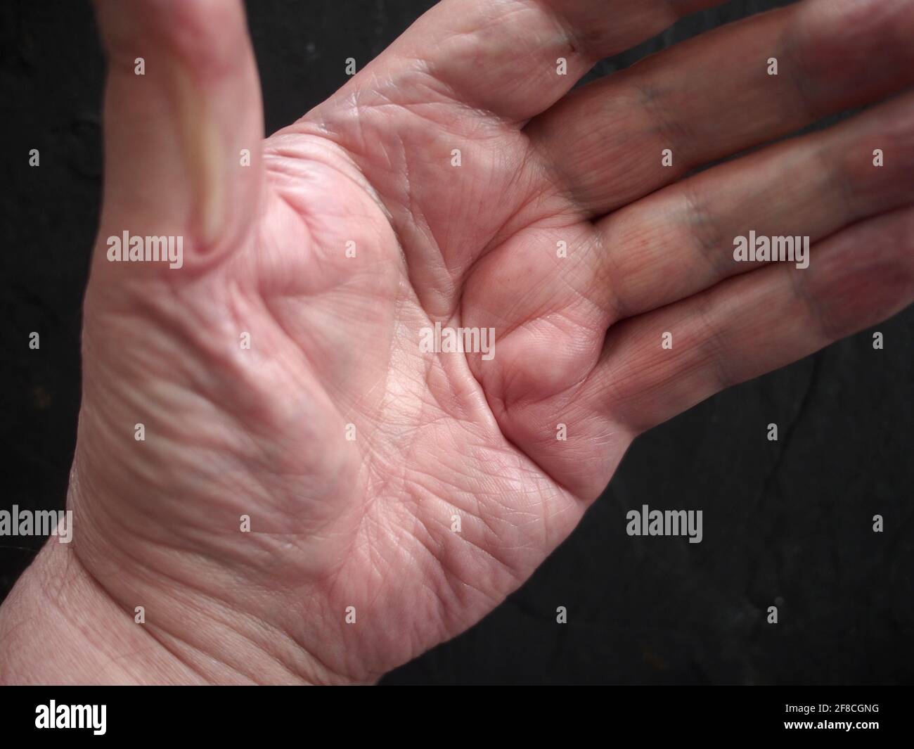 Dupuytrens contracture hi-res stock photography and images - Alamy