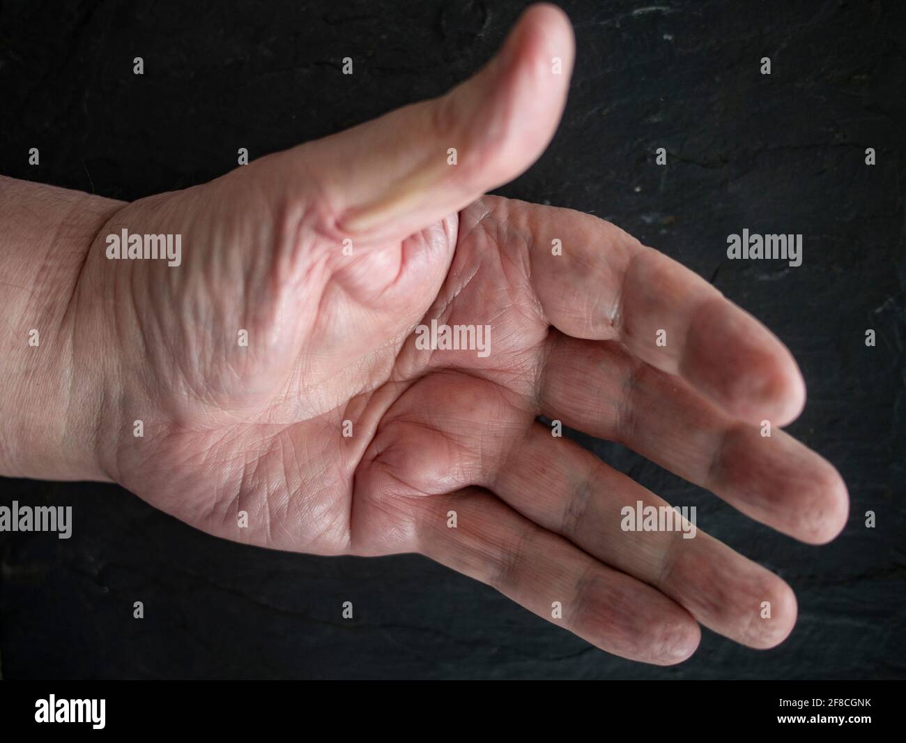 DuPuytren's Contracture in the Left Hand Stock Photo - Alamy