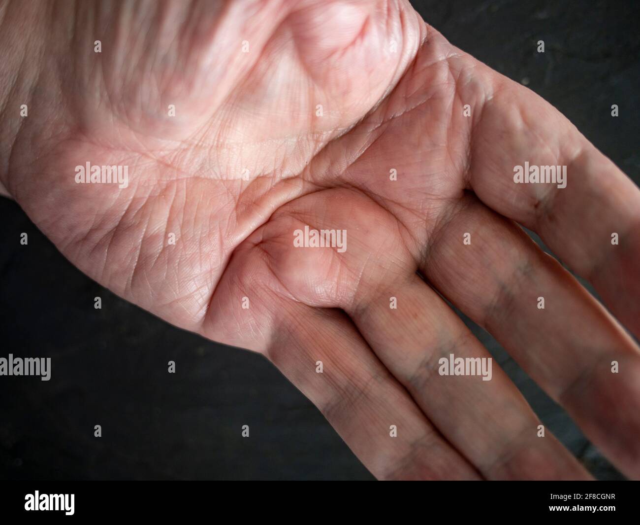 Dupuytrens contracture hi-res stock photography and images - Alamy