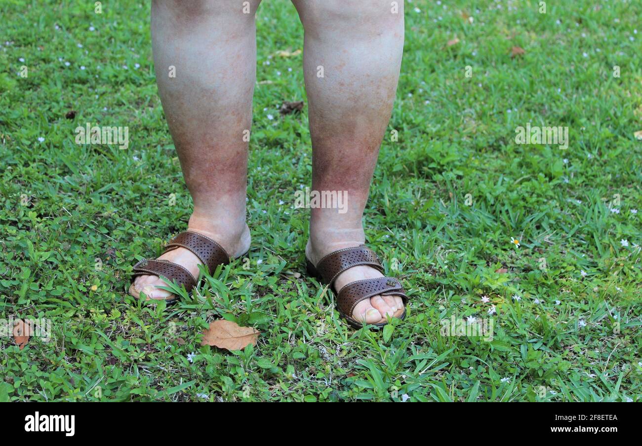 Woman's legs, she is suffering from Chronic Venous Insufficiency with ...