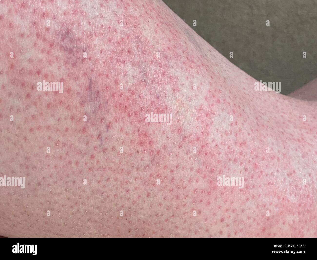 mottled skin heat rash hives allergy reaction on knee close-up ...
