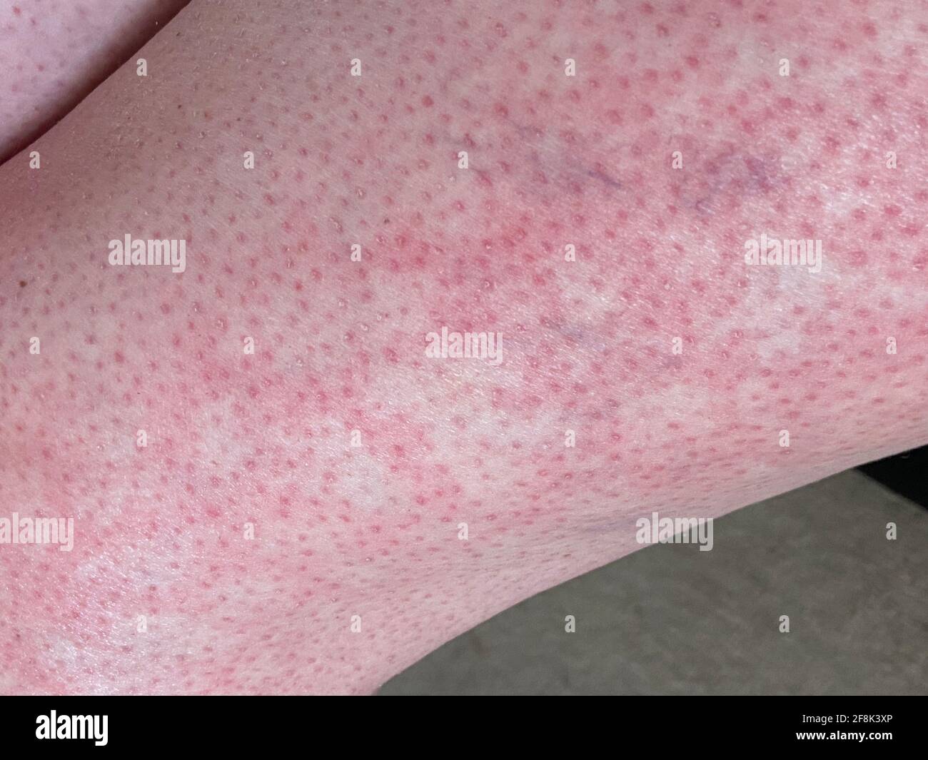 mottled skin heat rash hives allergy reaction on knee close-up ...