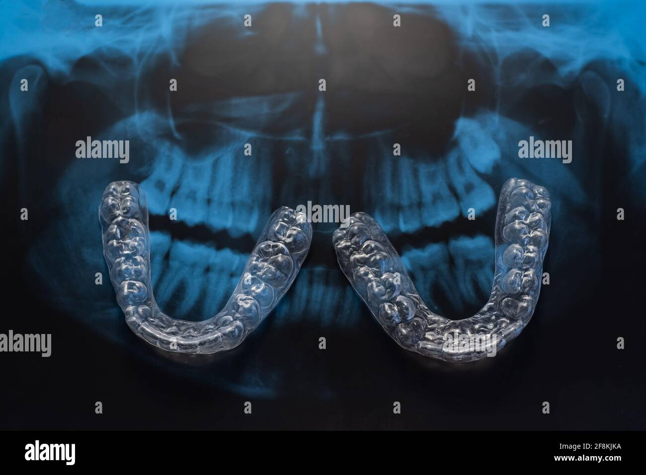 Transparent bite correction trays and x-ray of the jaw. Orthodontist ...