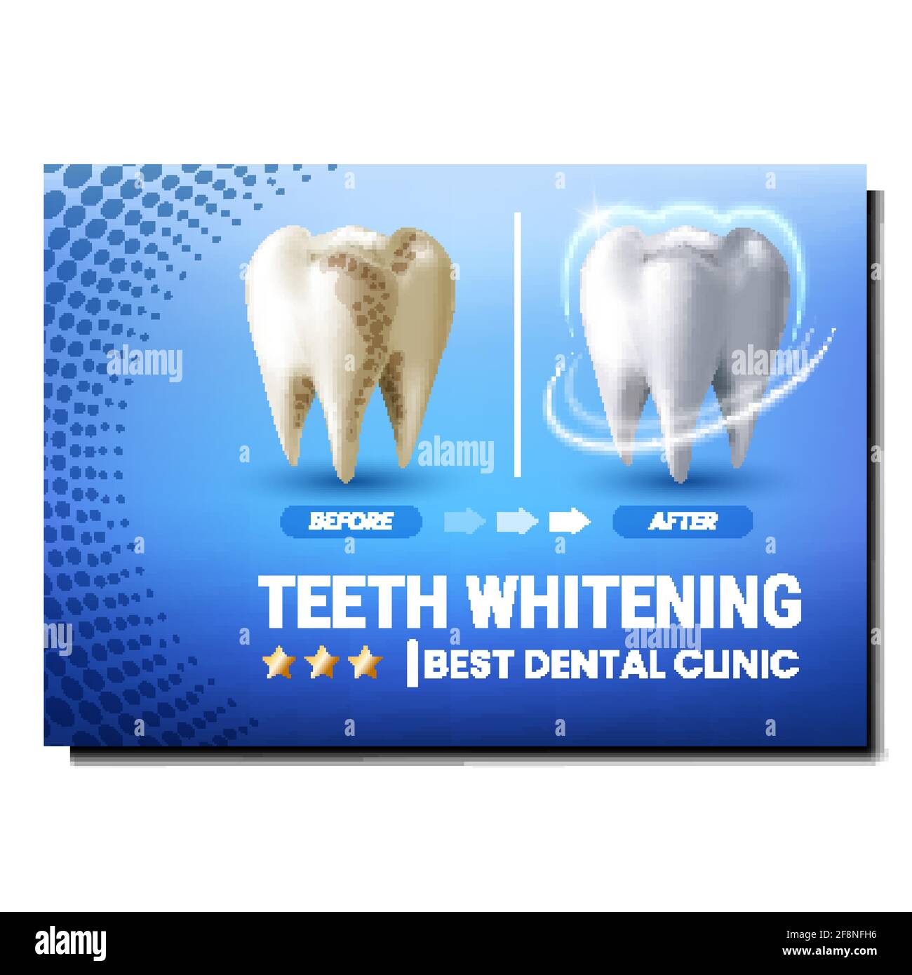 Teeth Whitening Creative Promotional Poster Vector Stock Vector Image ...