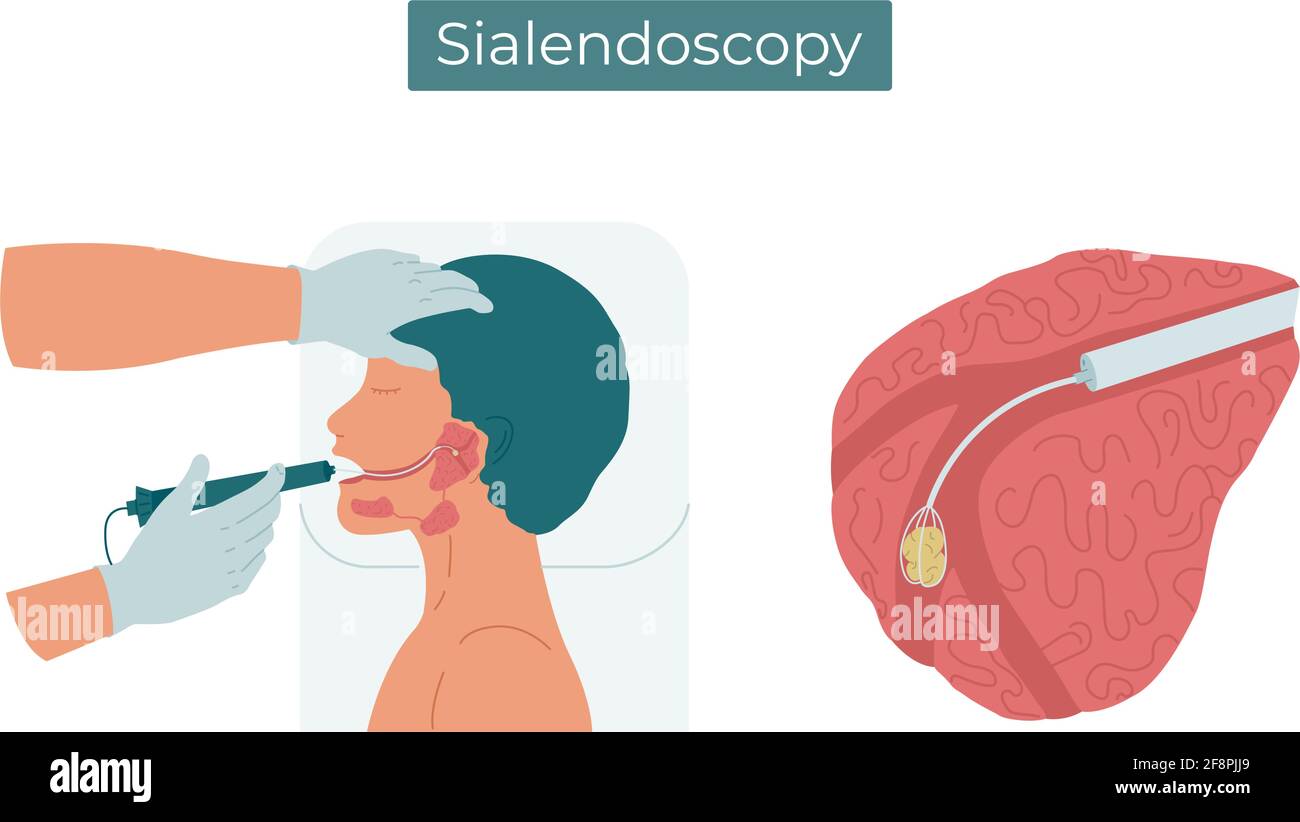 Vector flat illustration of sialendoscopy. Surgery to remove a stone ...