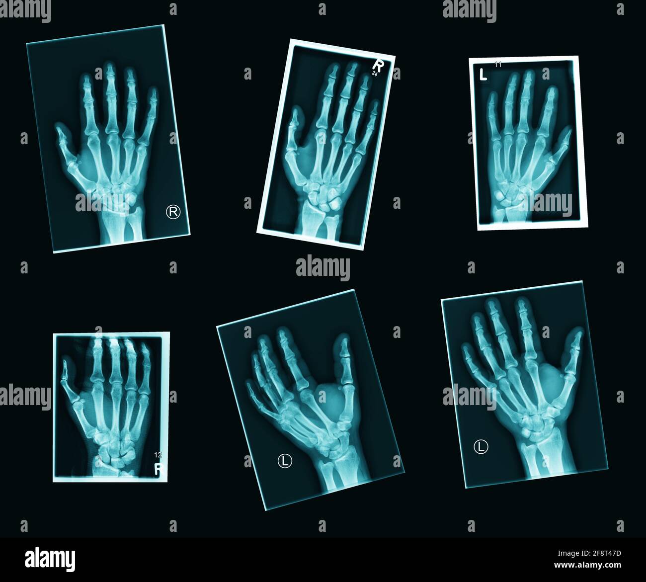 Illustration of six different human hands xrays Stock Photo - Alamy