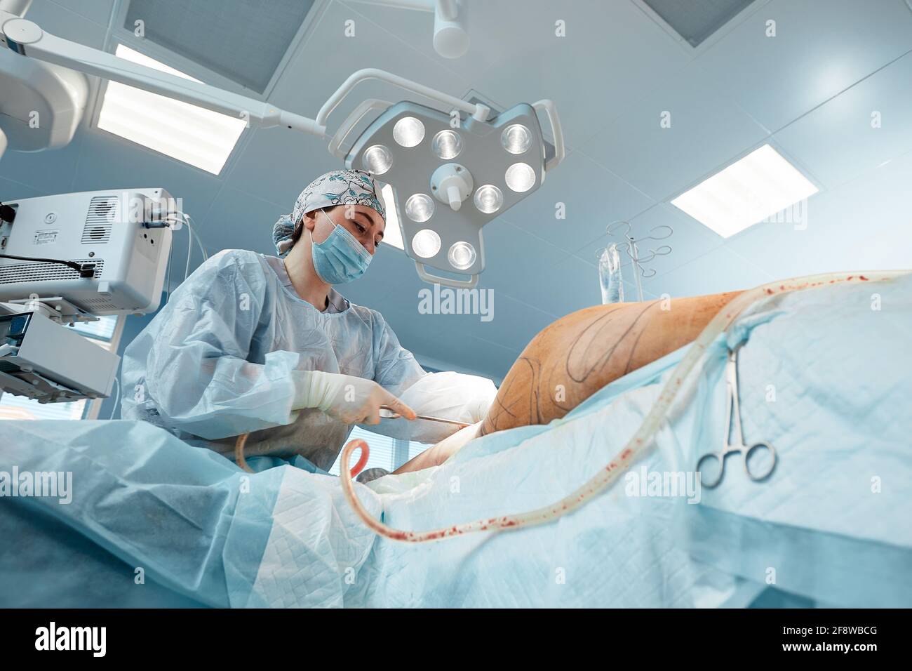 cosmetic liposuction surgery in actual operating room setting showing ...