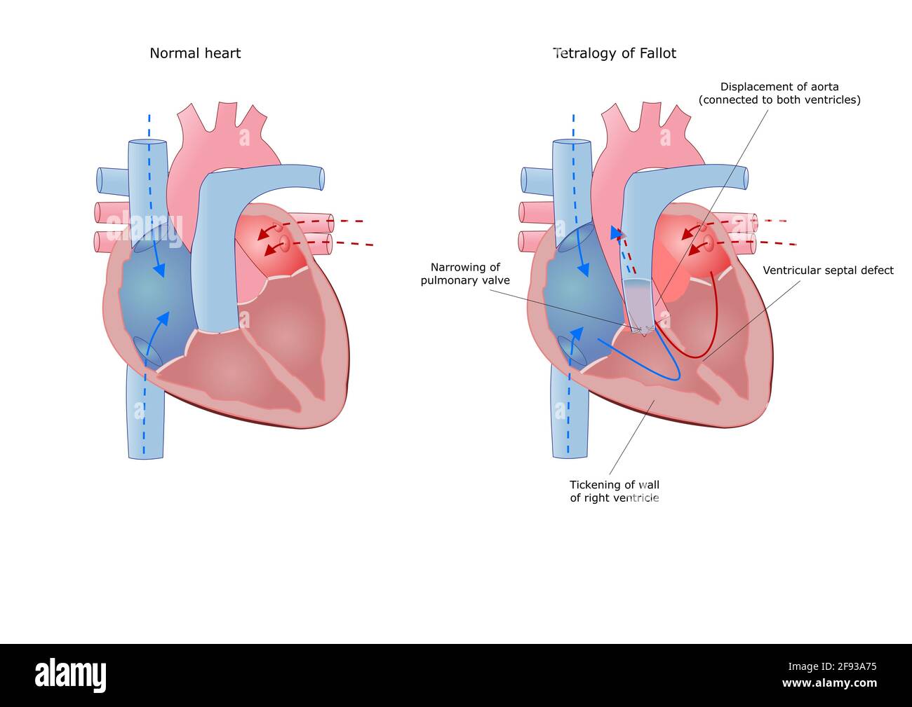 Tetralogy Of Fallot High Resolution Stock Photography and Images - Alamy