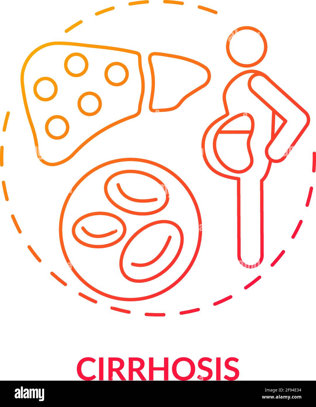 Liver cirrhosis drawing hi-res stock photography and images - Alamy