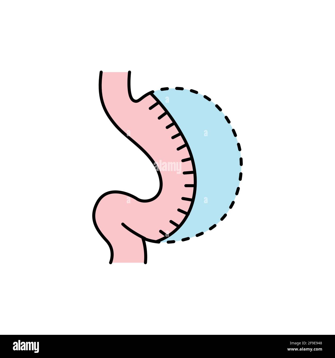 Bowel removal Stock Vector Images - Alamy