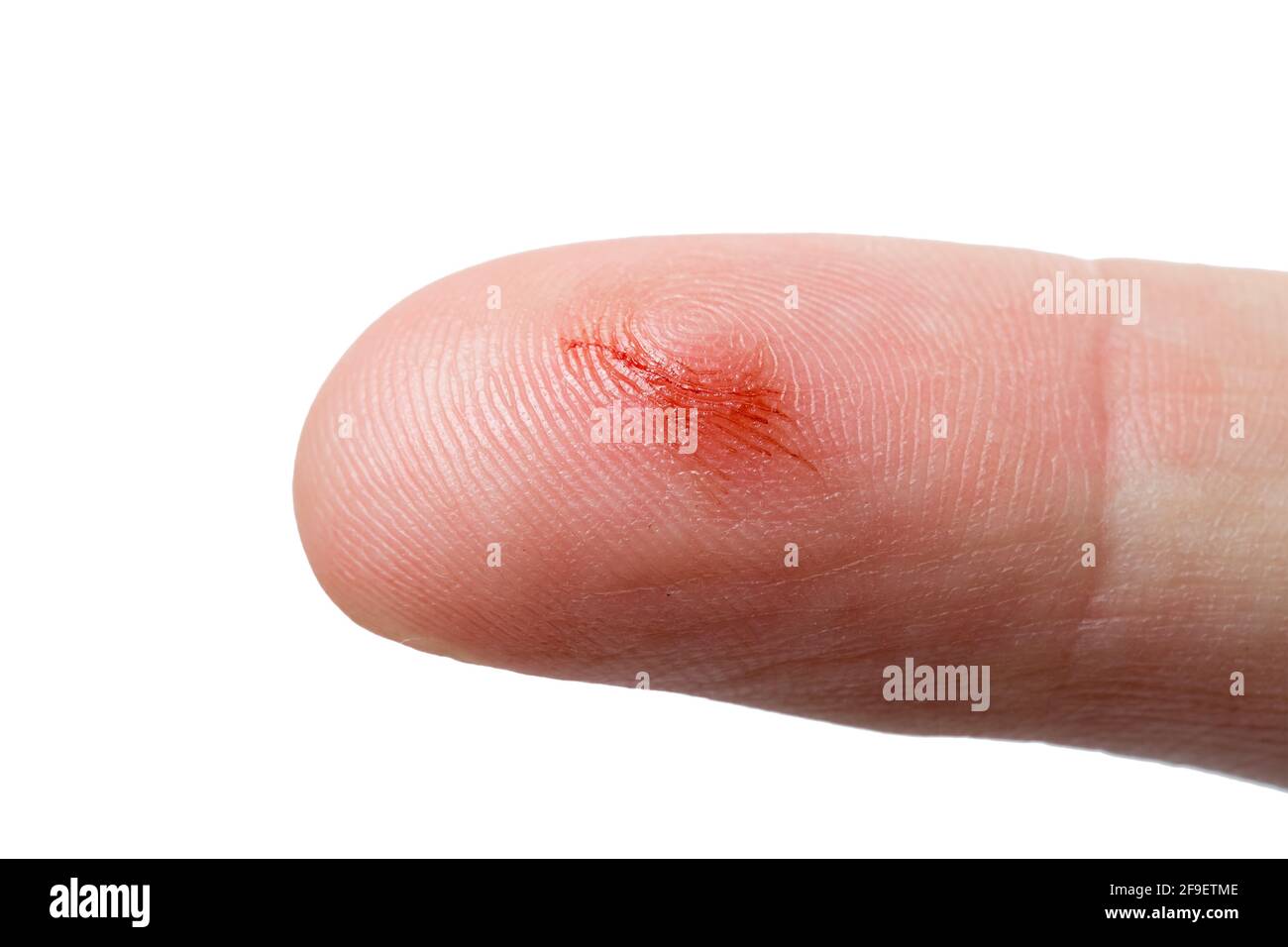 forefinger of the hand with a scratch and a drip of blood from a skin ...