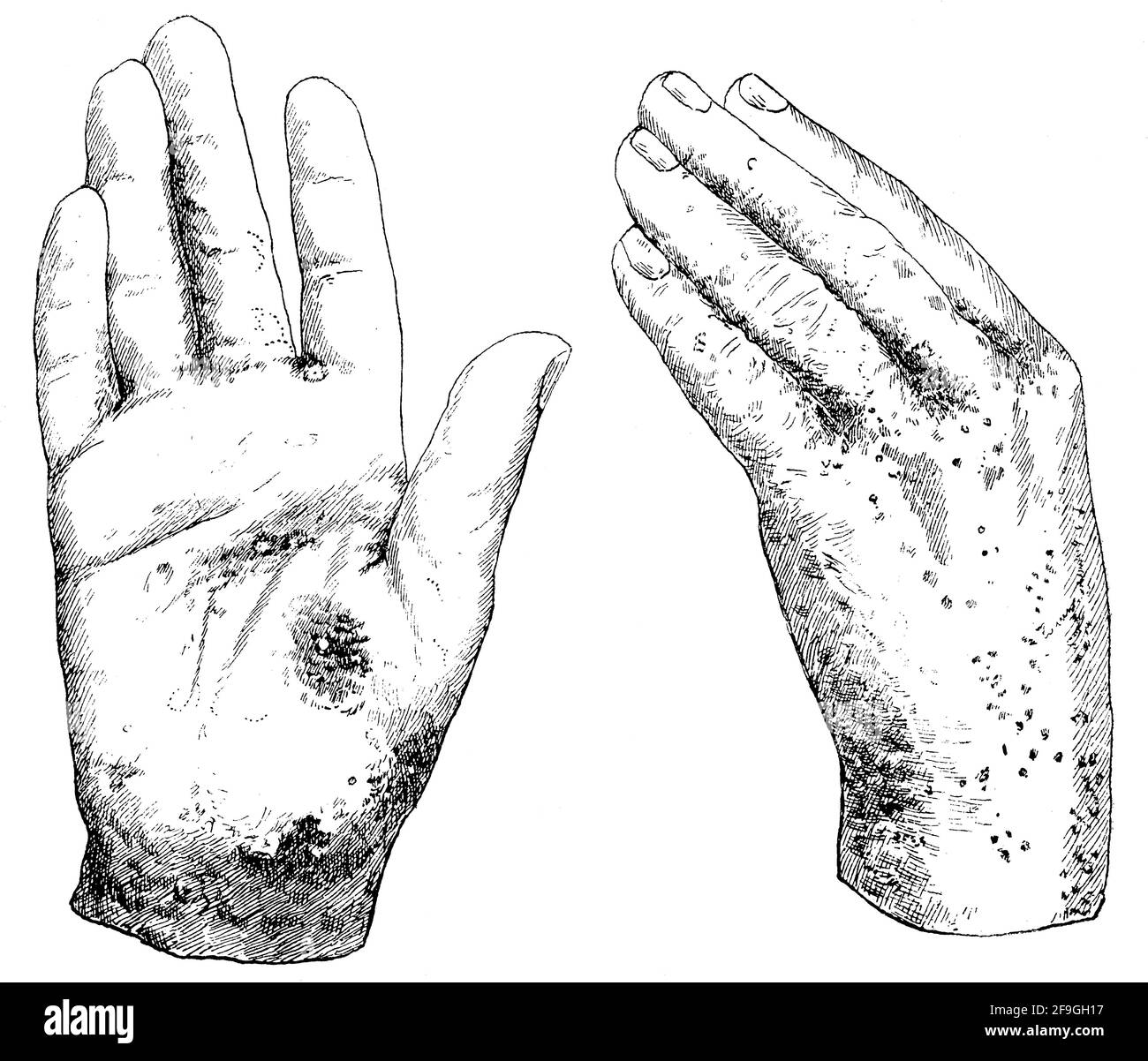 Scabies mite hi-res stock photography and images - Alamy
