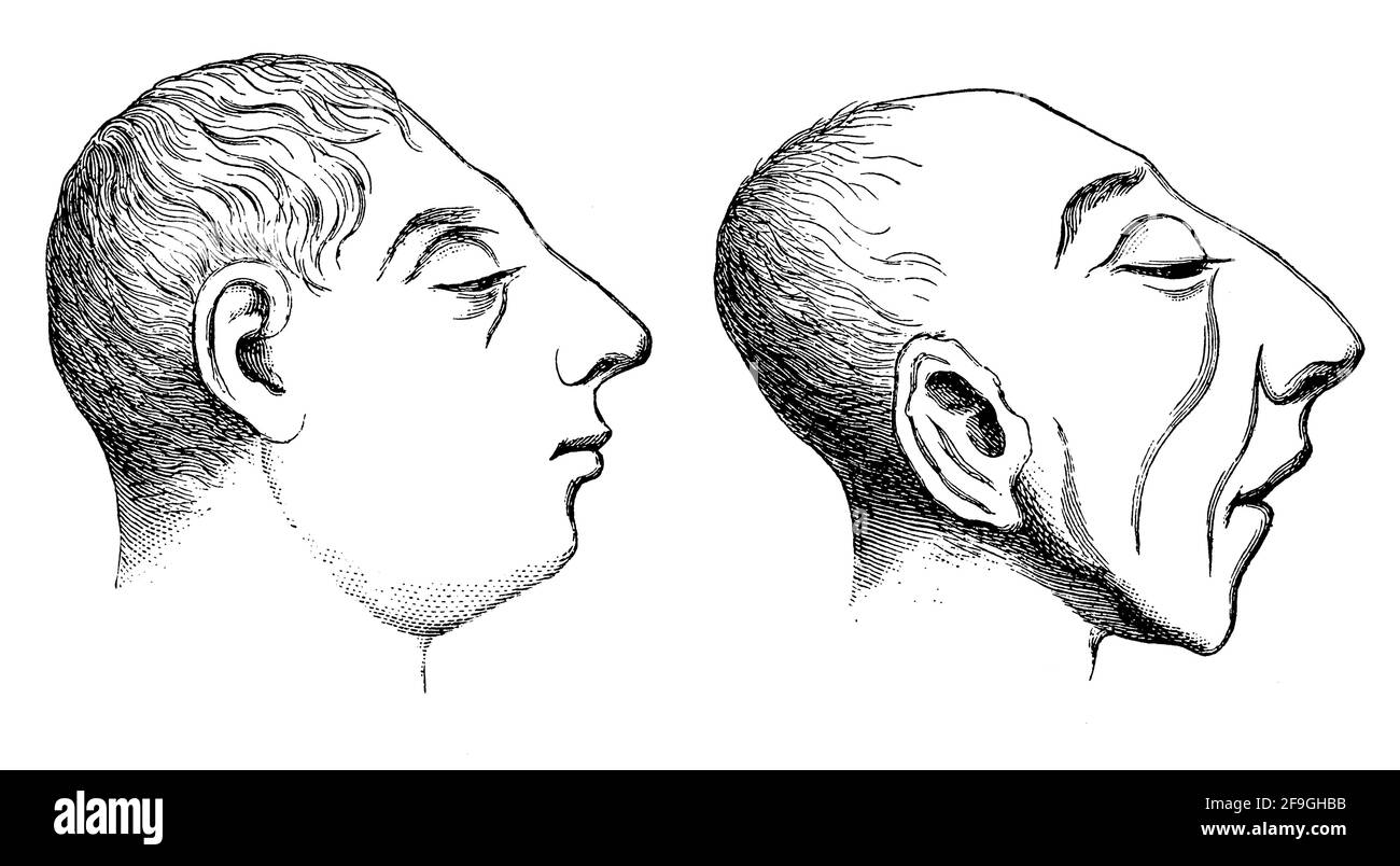 Untreated Congenital Hypothyroidism