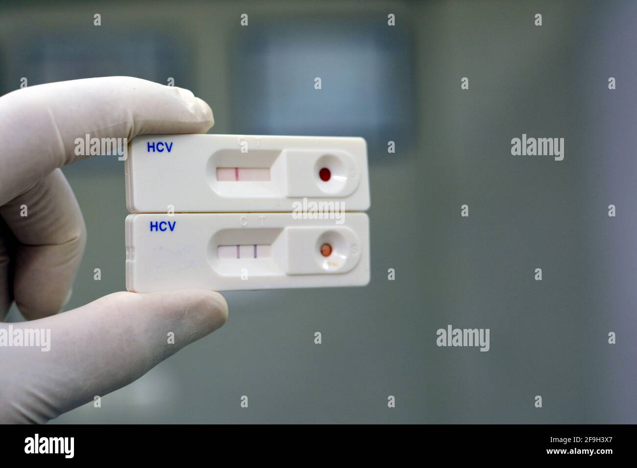2 rapid test results for Hepatitis c Virus, a negative and a positive ...