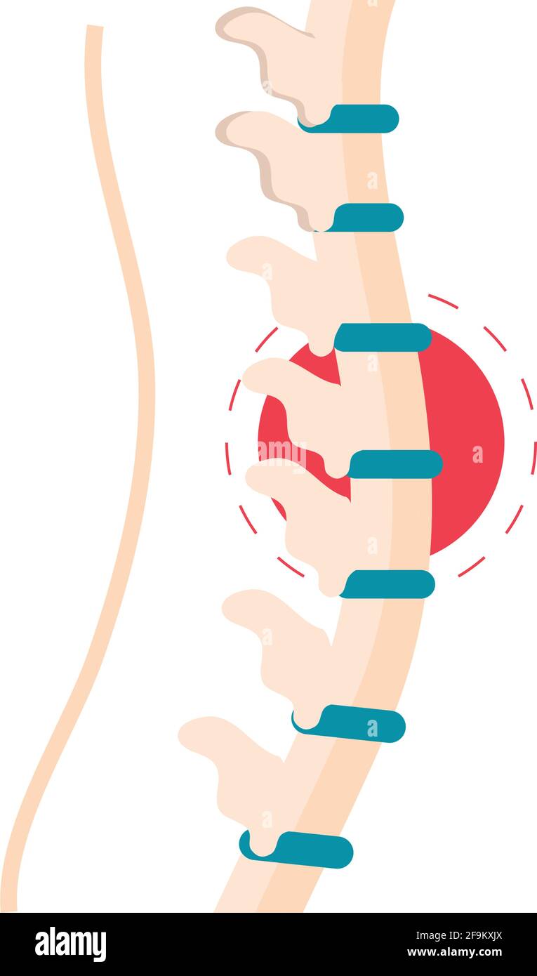 rheumatism vertebral column joints isolated Stock Vector Image & Art ...