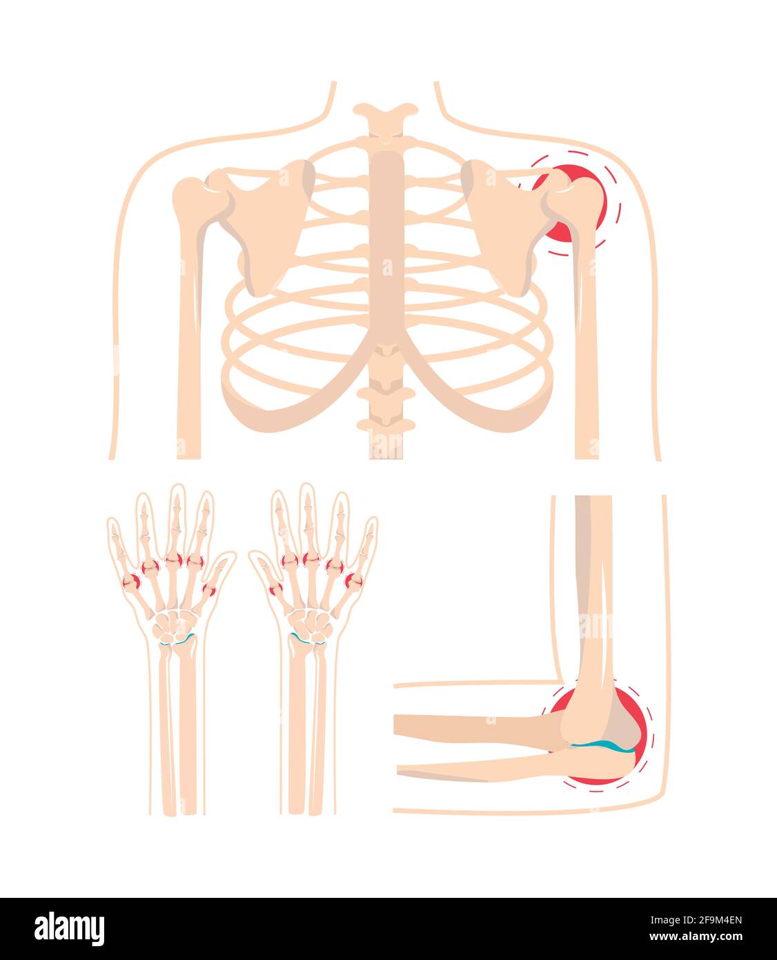 arthritis painful injury human bones Stock Vector Image & Art - Alamy