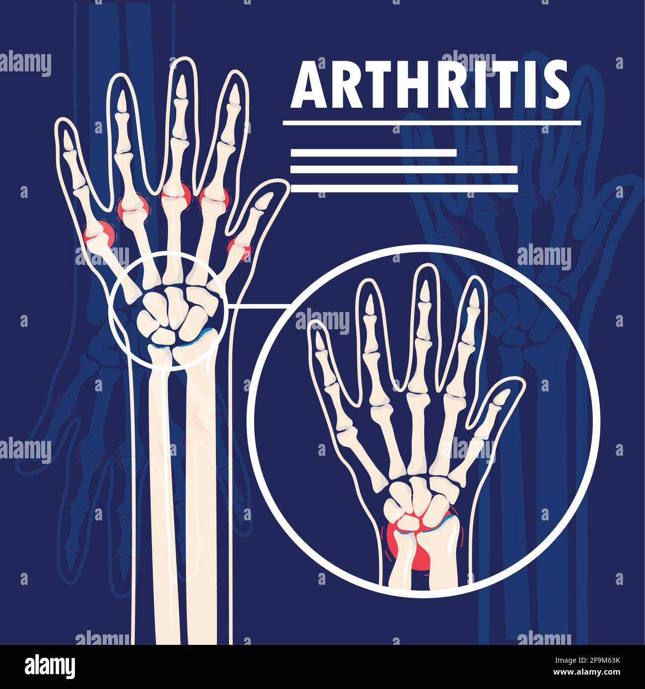 Hand deformity Stock Vector Images - Alamy