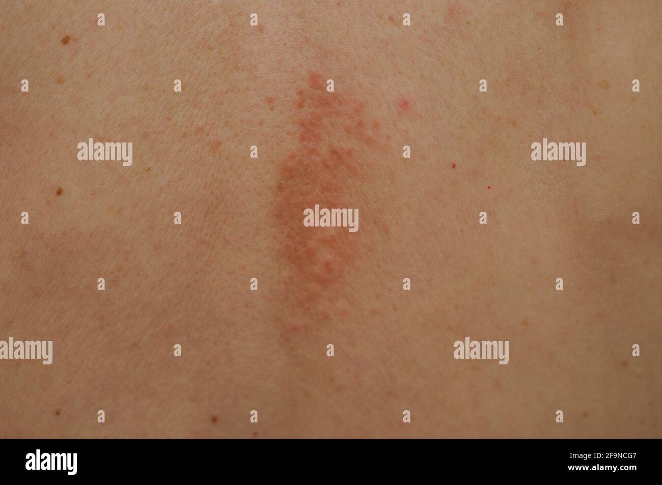 Eczema pimples on a back Stock Photo - Alamy