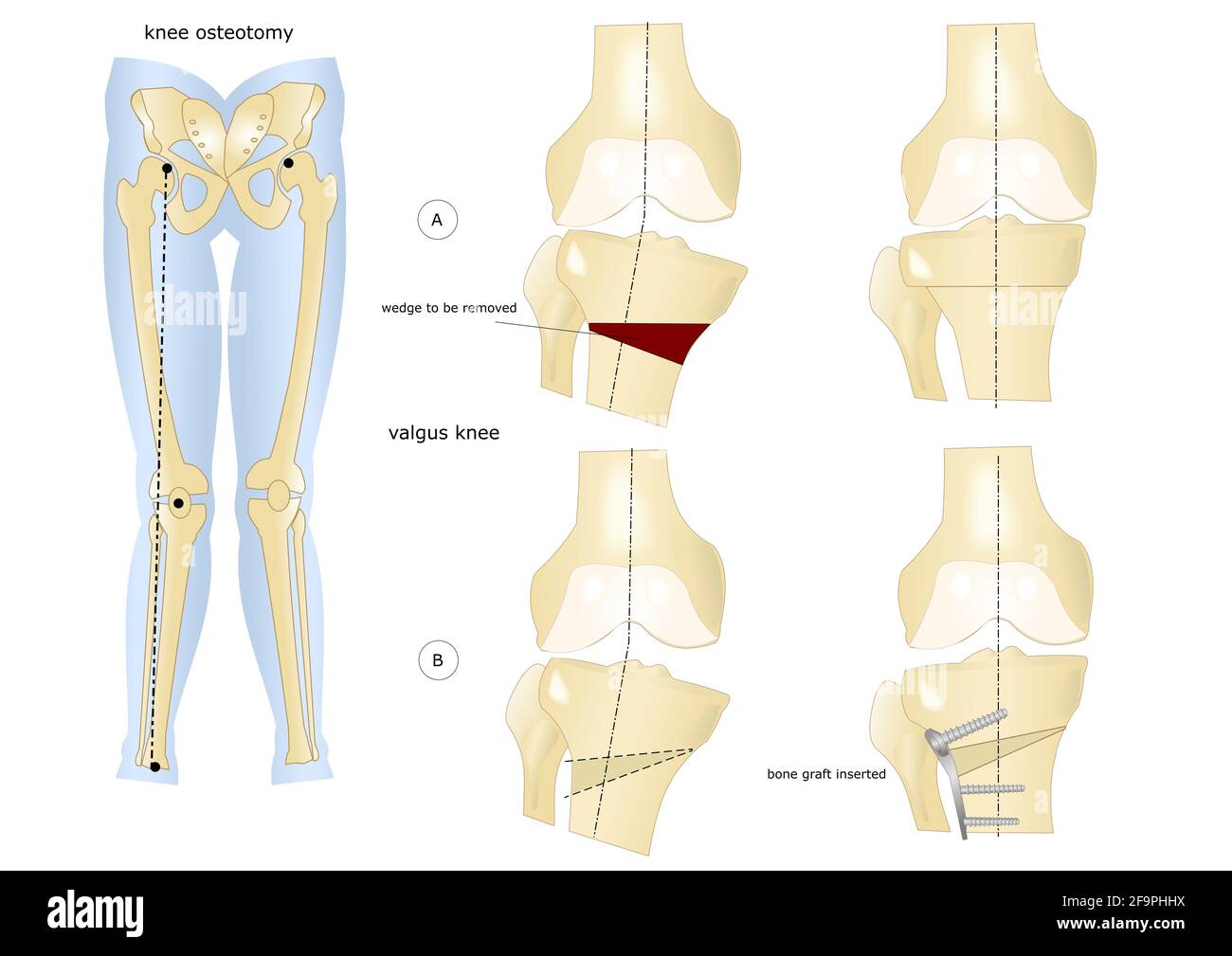 Osteotomy High Resolution Stock Photography and Images - Alamy