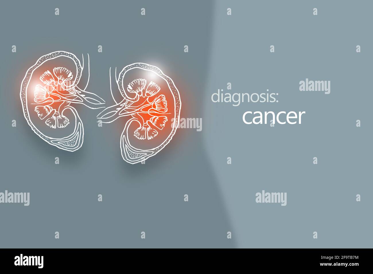 Cancer kidney disease or renal cell carcinomas. Malignant kidney tumors ...