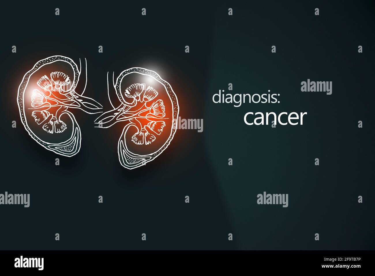 Cancer kidney disease or renal cell carcinomas. Malignant kidney tumors ...