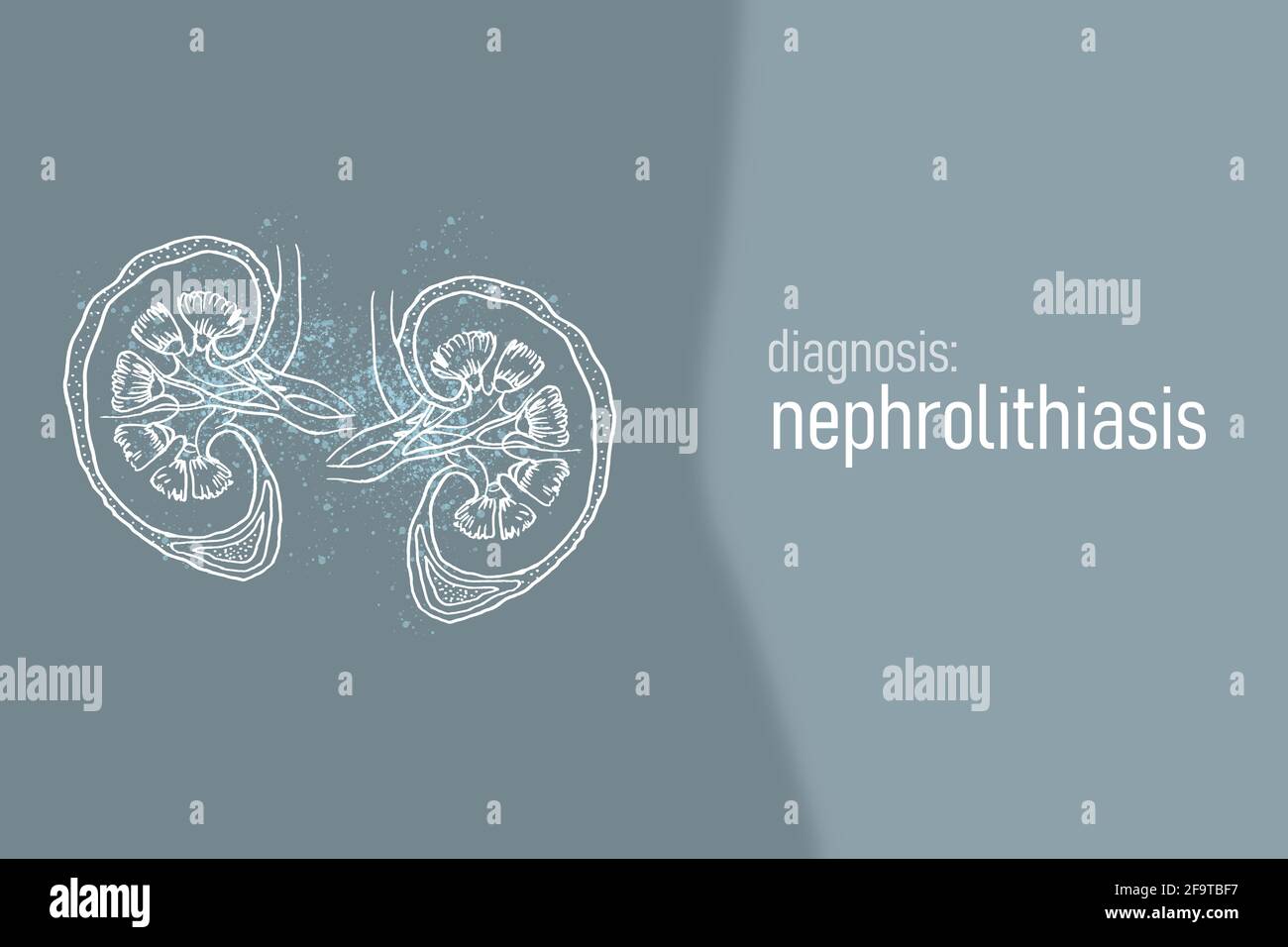 Nephrolithiasis kidney stones disease or urolithiasis. Renal Calculus ...