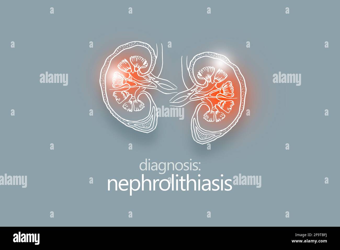 Nephrolithiasis kidney stones disease or urolithiasis. Renal Calculus ...