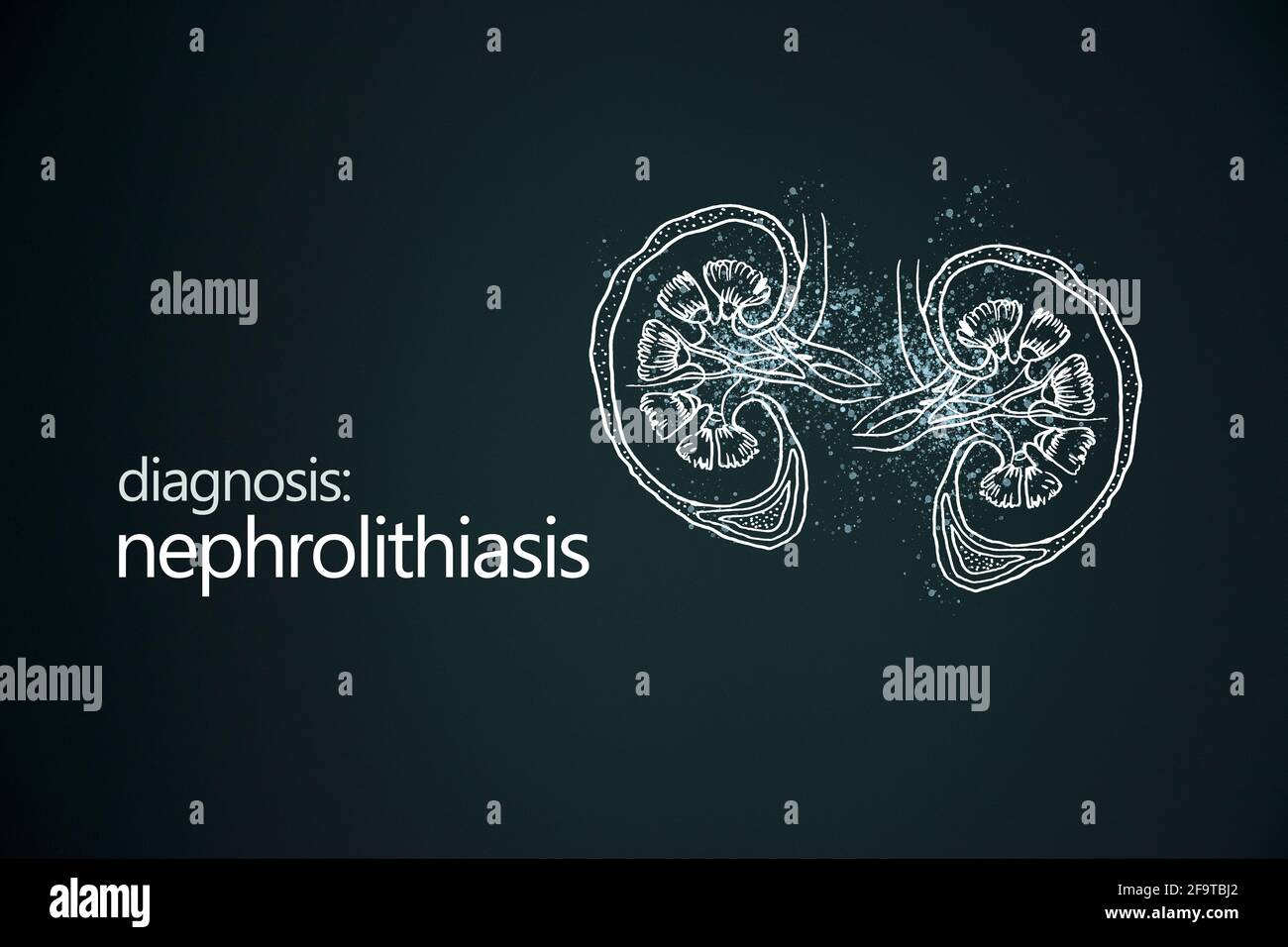 Nephrolithiasis kidney stones disease or urolithiasis. Renal Calculus ...