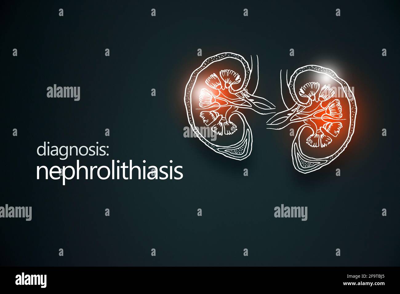 Nephrolithiasis kidney stones disease or urolithiasis. Renal Calculus ...
