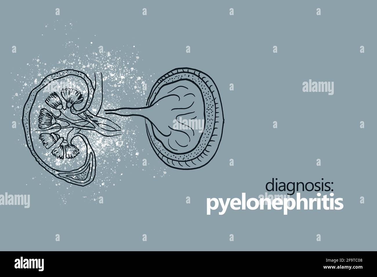 Pyelonephritis, aninflammation of the kidney, typically due to a ...