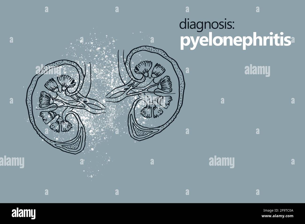 Pyelonephritis, aninflammation of the kidney, typically due to a ...