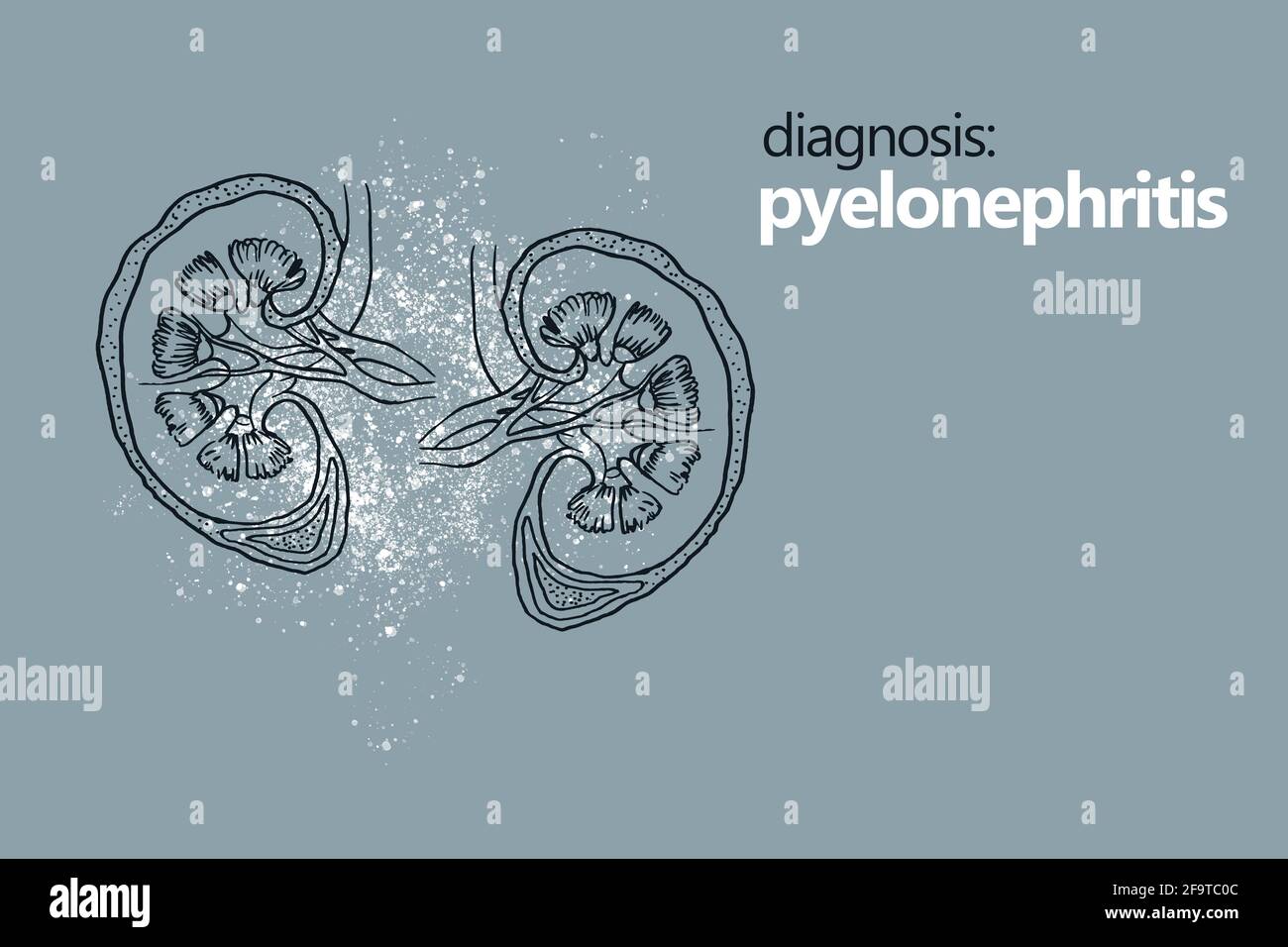 Pyelonephritis, aninflammation of the kidney, typically due to a ...