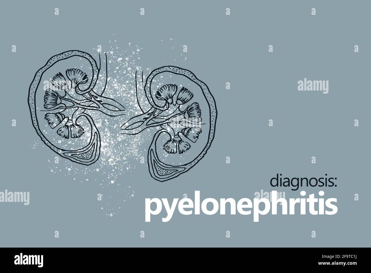 Pyelonephritis, aninflammation of the kidney, typically due to a ...
