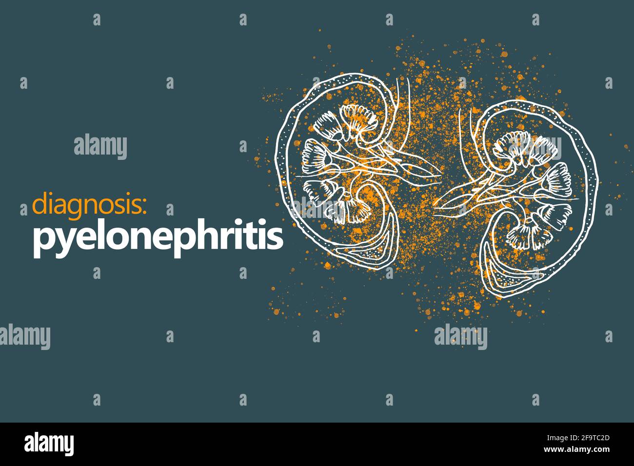 Pyelonephritis, aninflammation of the kidney, typically due to a ...