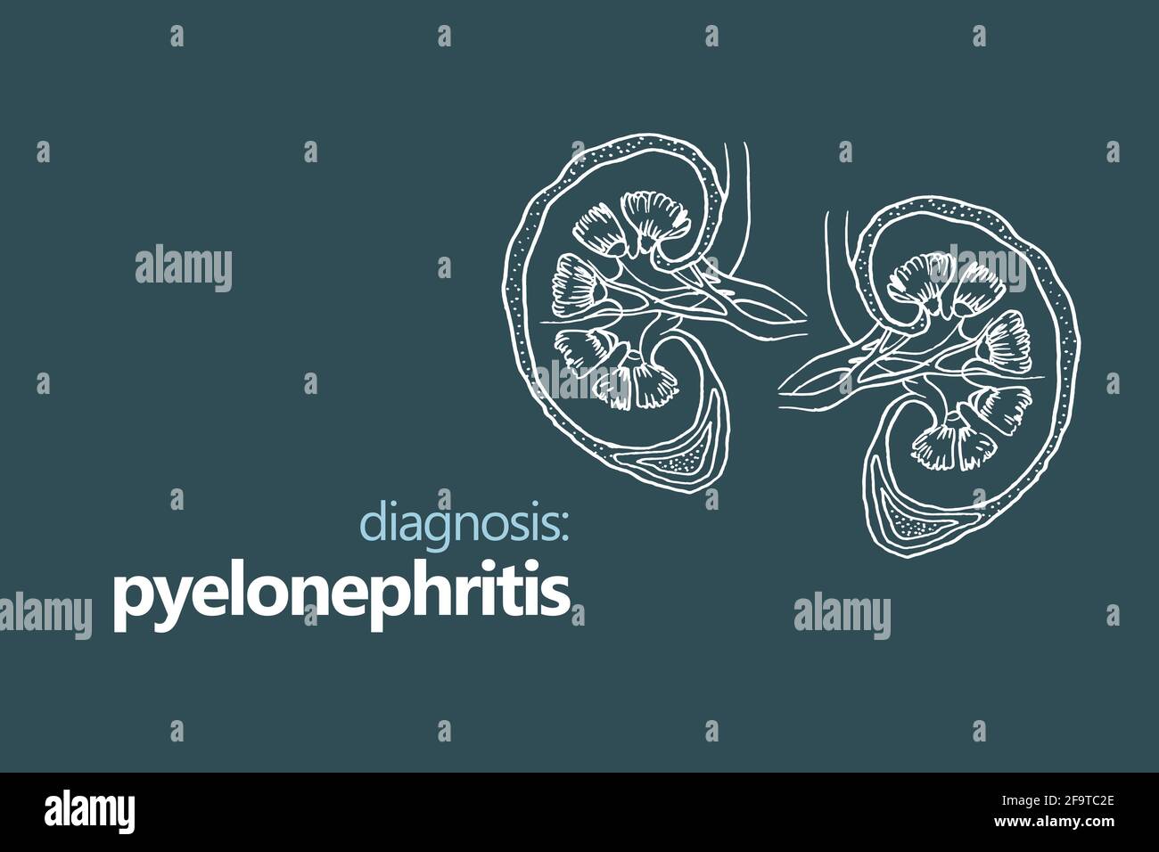 Pyelonephritis, aninflammation of the kidney, typically due to a ...