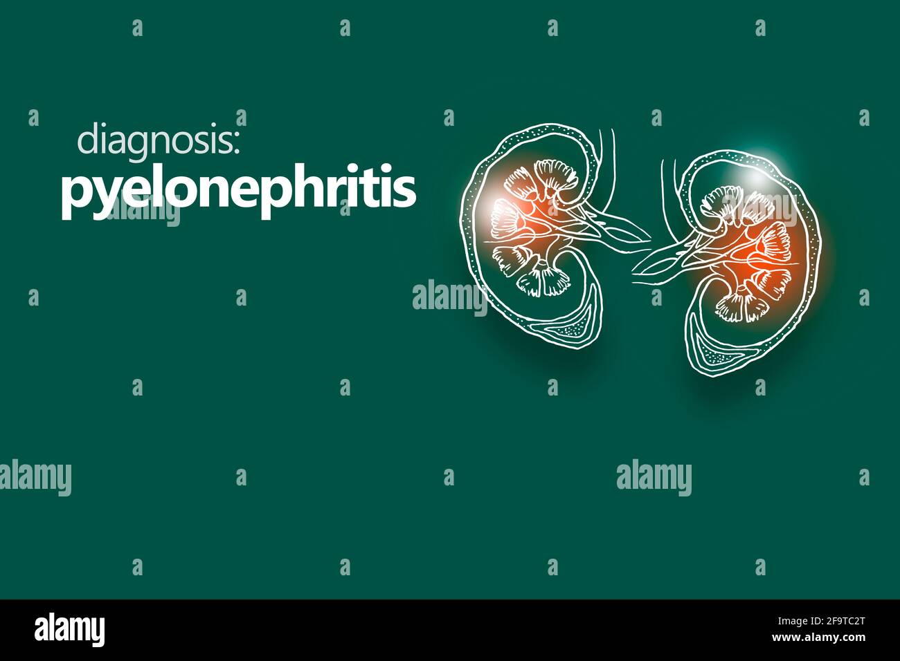 Pyelonephritis, aninflammation of the kidney, typically due to a ...
